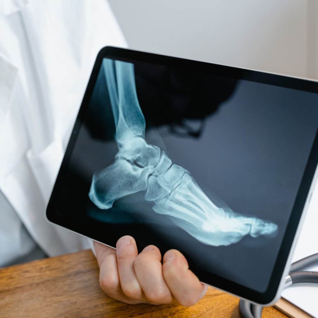 Case Study: Bilateral Foot Drop - Orthopaedics International
