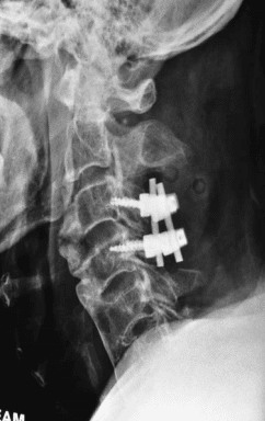 Case Study: Acute Severe Central Cord Syndrome | Orthopaedics International