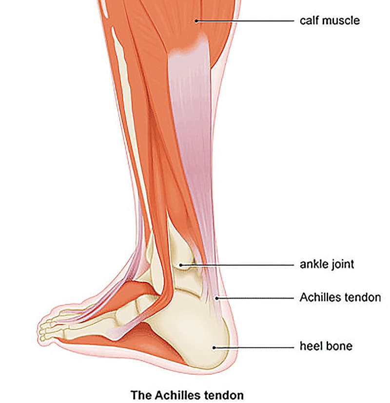 Understanding Achilles Tendonitis: Causes, Symptoms, and Treatments ...